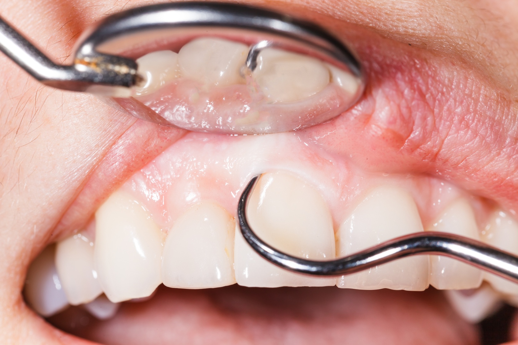 Diabetes Dental Problems